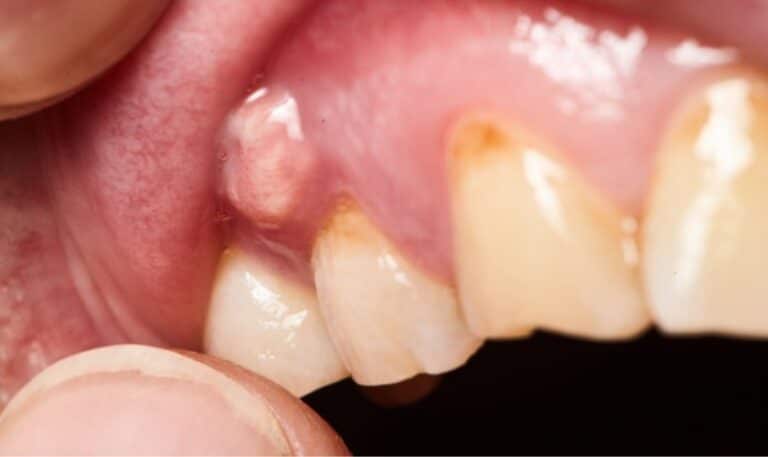 What to Do If a Root Canal Gets Infected?